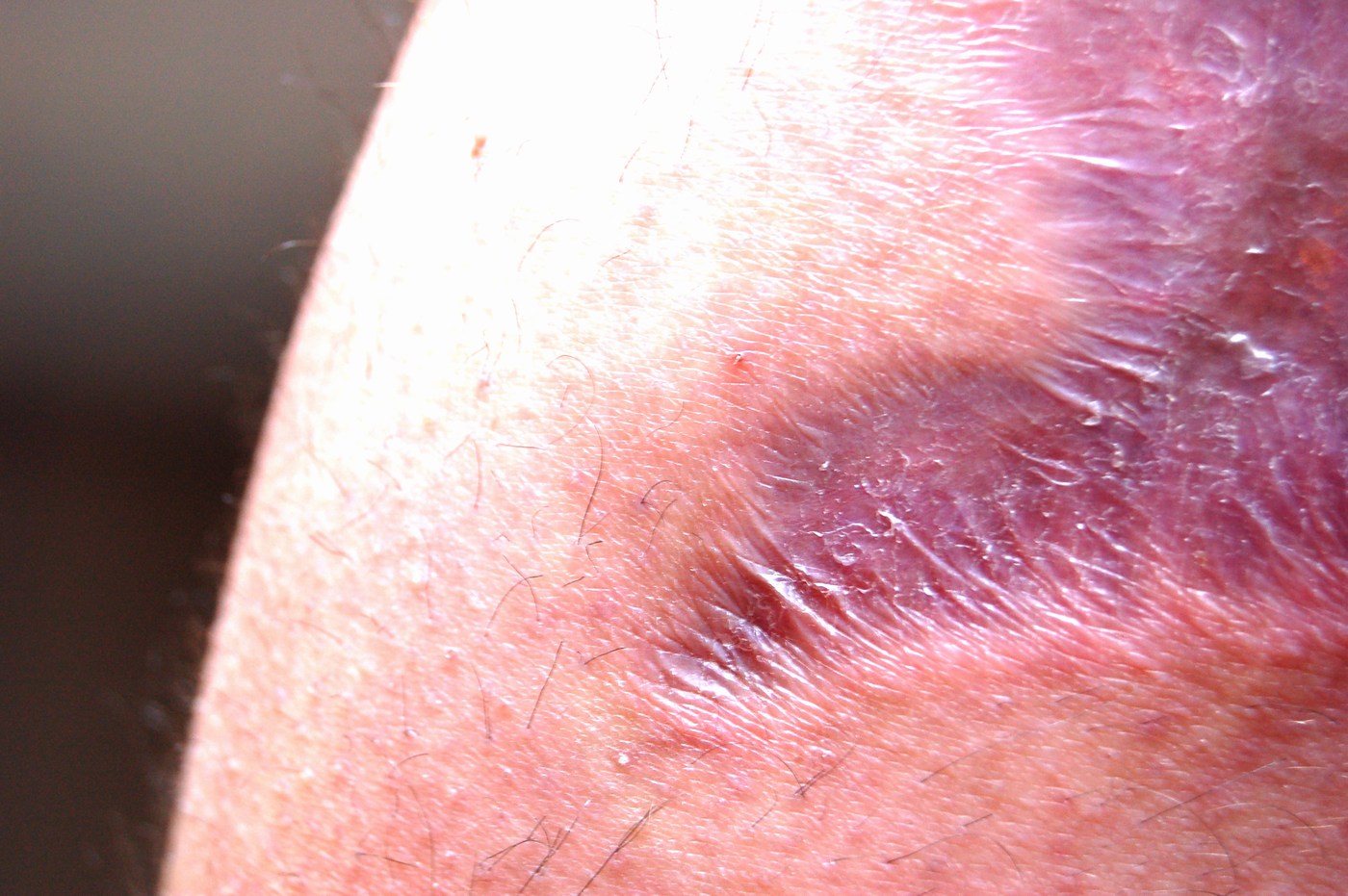 Immagini Del Morso Del Ragno Violino Stadio 1 Come Riconoscere Il