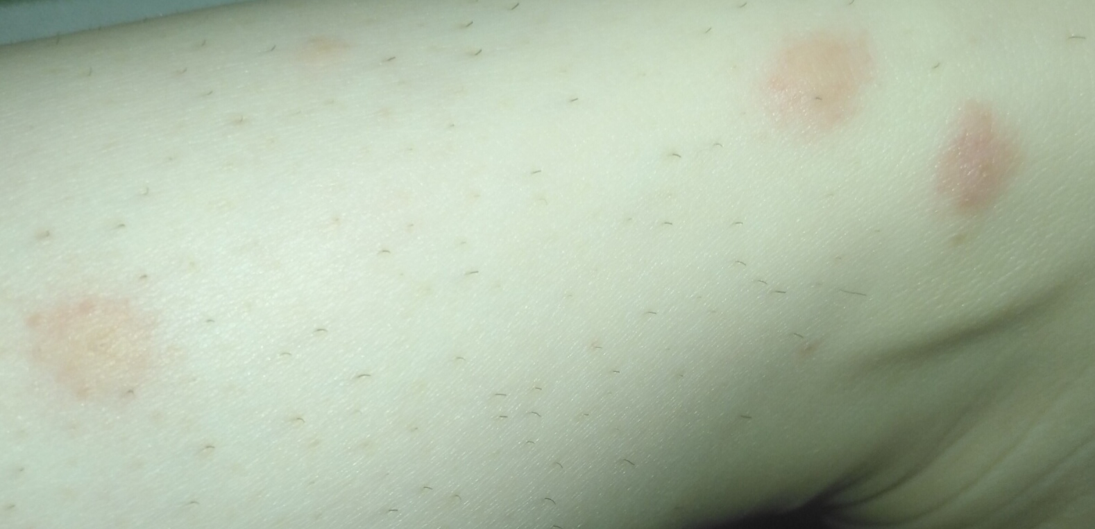 Pomfi su tutto il corpo aiuto! , Natura Mediterraneo | Forum Naturalistico