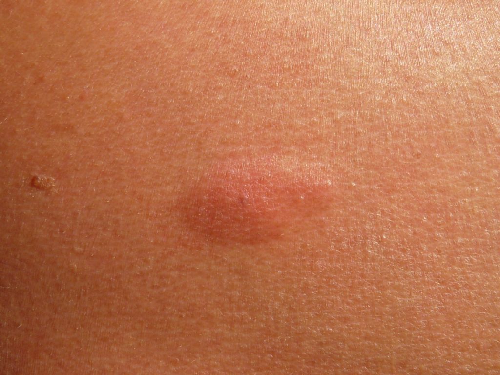 POMFI E DERMATITE ALLERGICA , Natura Mediterraneo | Forum Naturalistico